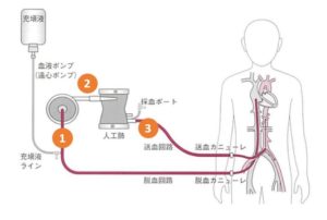 ミキシングポイント(Mixing Point)とは？【ECMO】｜踊る救急医