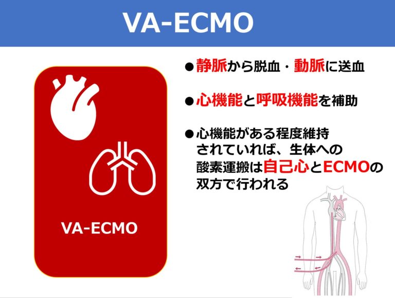 ECMOとは？【ECMO・PCPSについて簡単に解説】｜踊る救急医