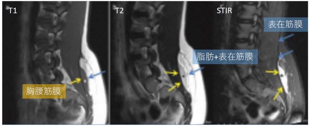Morel Lavallée lesion (MLL)とは？【重症外傷で見られる血腫では注意すべき疾患です】｜踊る救急医
