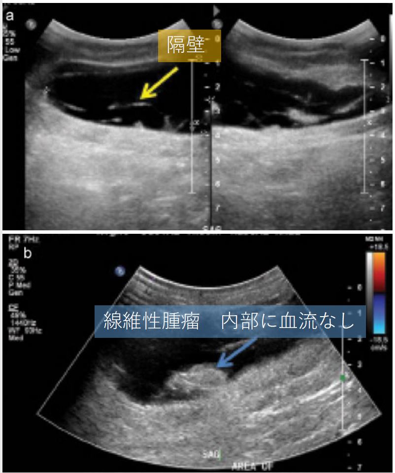 Morel Lavallée lesion (MLL)とは？【重症外傷で見られる血腫では注意すべき疾患です】｜踊る救急医