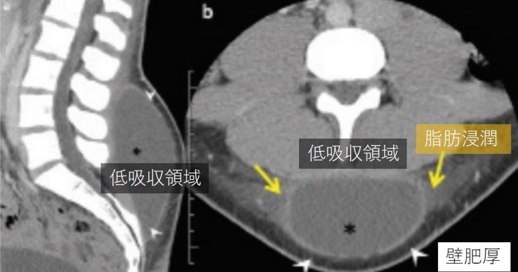 Morel Lavallée lesion (MLL)とは？【重症外傷で見られる血腫では注意すべき疾患です】｜踊る救急医