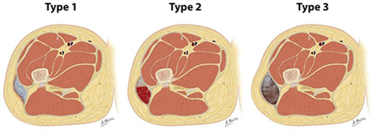 Morel Lavallée lesion (MLL)とは？【重症外傷で見られる血腫では注意すべき疾患です】｜踊る救急医